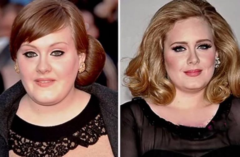 Adele’s Before and After Surgery Photos Show Proof of the Singer’s ...
